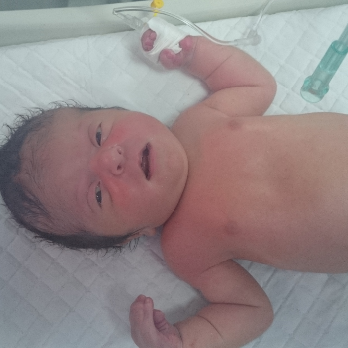 Baby Eyas Medical Fund, apert syndrome surgeries by Eyas Daraghmi ...