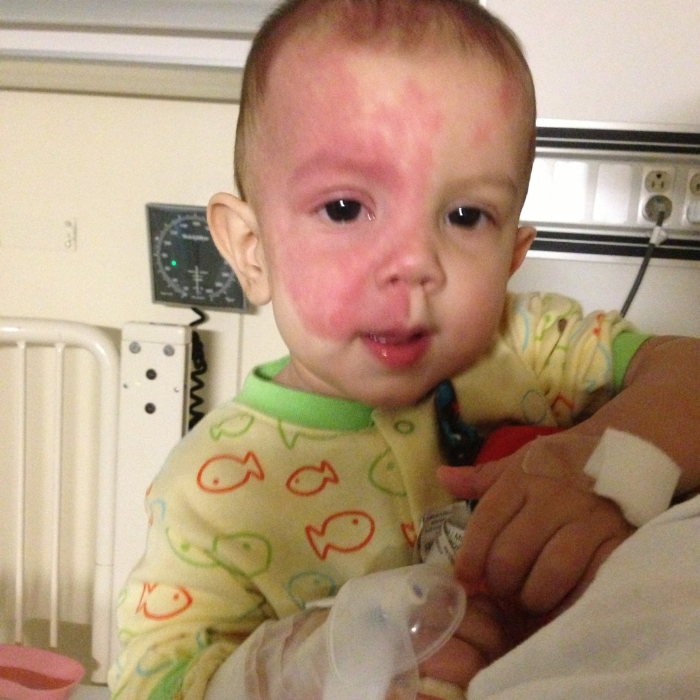Help Baby Lucas Diagnosed with Sturge Weber Syndrome SWS by Aunties ...