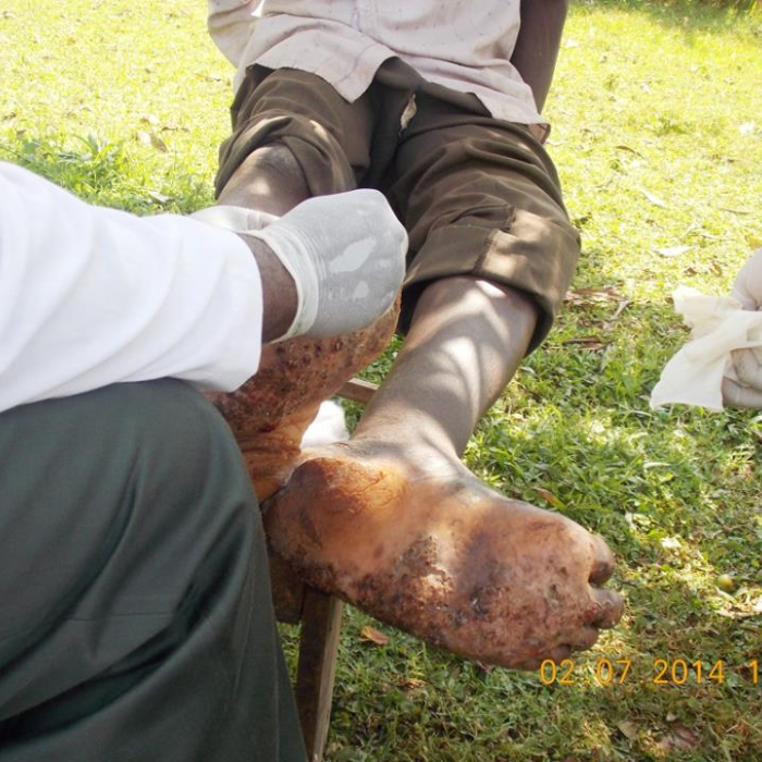 Kill the jigger bug in Africa by Jim Nduruchi - Indiegogo
